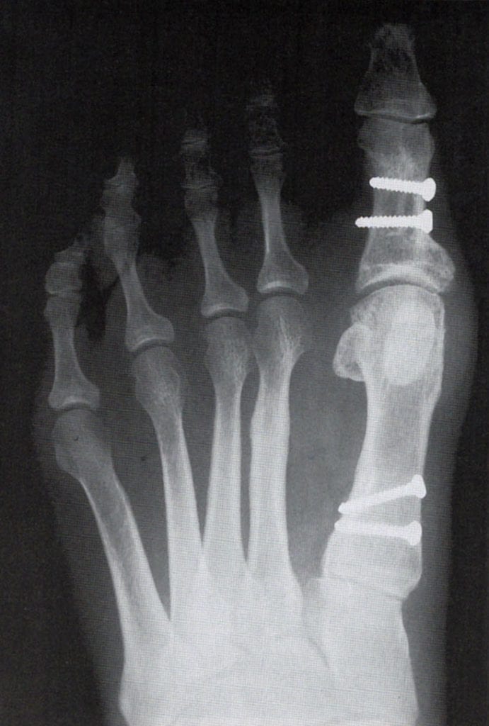 Moy’s Procedures V.S. Others – Dr. Moy's Painless Bunion Surgery