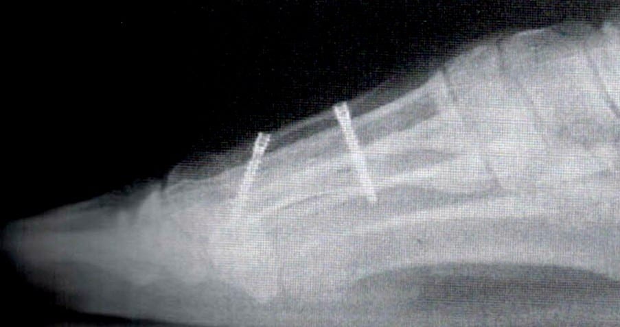 Moy's Procedures V.S. Others - Dr. Moy's Painless Bunion Surgery