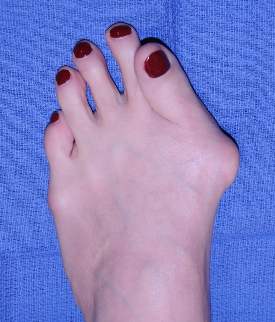 Bunion – Dr. Moy's Painless Bunion Surgery