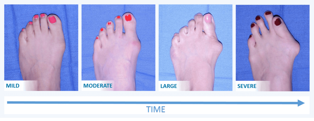 Bunion Surgery – Dr. Moy's Painless Bunion Surgery