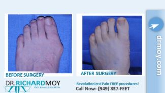 Bunion Surgery Before and After - Painless Bunion Surgery by Dr. Moy